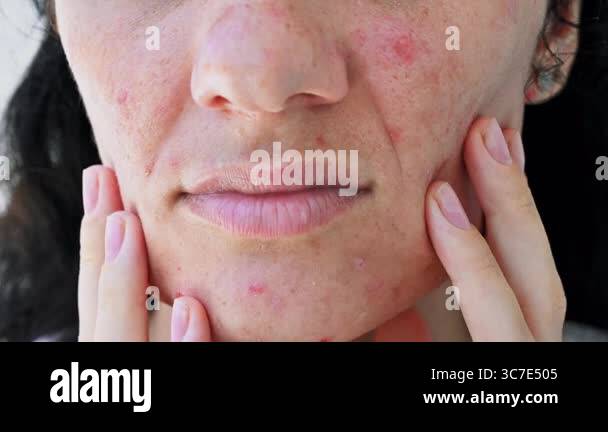 Close-up of the skin of a young girl with problems. Pimples, acne ...