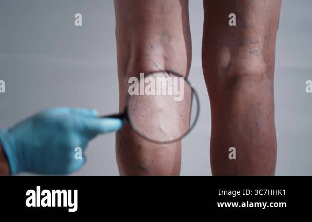 A medical professional analyzes swollen leg veins under a magnifying ...