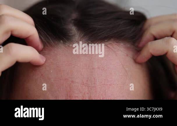 Woman scratching scalp because of dandruff. 4K, slow motion Stock Video ...