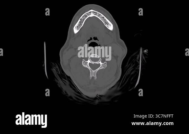 Axial computed tomography (CT) scan of a Jefferson fracture, a fracture ...