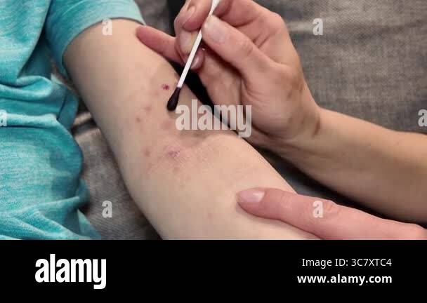A child illness skin rash epidemic with vaccination indoors Stock Video ...