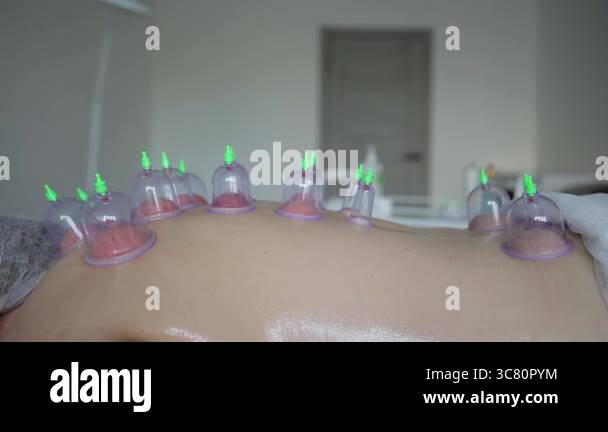 Cupping therapy is a popular method of muscle relaxation and effective ...
