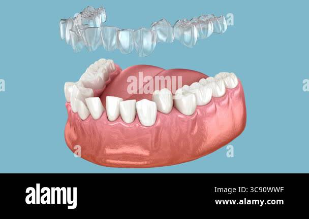 Invisalign braces or invisible retainer make bite correction. Medically ...