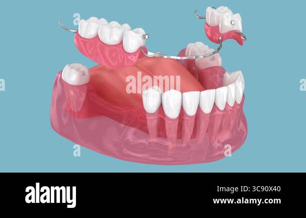 Removable partial denture, mandibular prosthesis. Medically accurate 3D ...