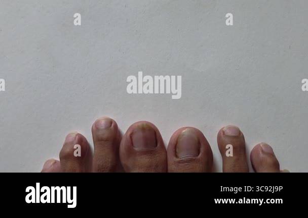 Male feet with visible dry skin and overgrown toenails resting flat on ...