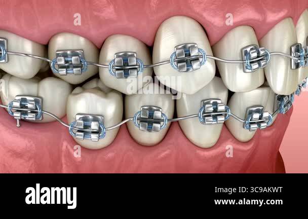 Teeth braces animation video in HD Stock Video Footage - Alamy