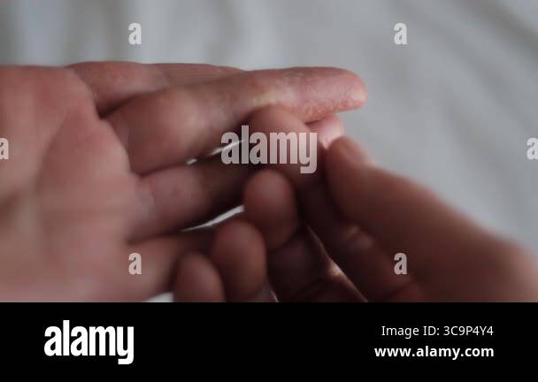 Cracked and peeling skin on the hands caused by dyshidrotic eczema ...