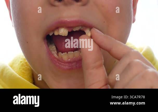 Pulled teeth Stock Videos & Footage - HD and 4K Video Clips - Alamy