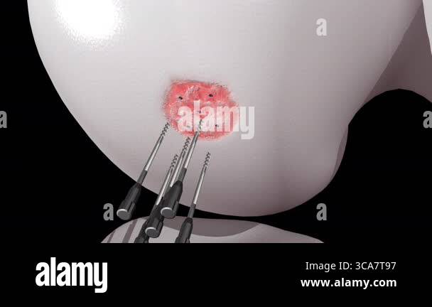 Knee cartilage transplants, animation. Cartilage covers the surface of ...