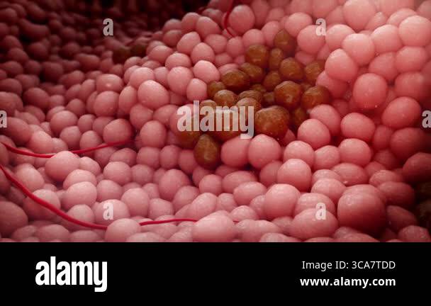 Ovarian cancer. Animation of ovarian cancer cells multiplying in the ...