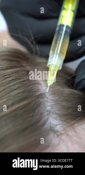 scalp injection, hair loss treatment, PRP therapy, mesotherapy scalp ...