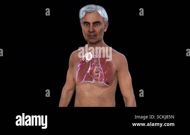 A man with lungs affected by cavitary tuberculosis in the upper lobe of ...