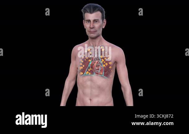 3D animation of a man with lungs affected by histoplasmosis, showing ...