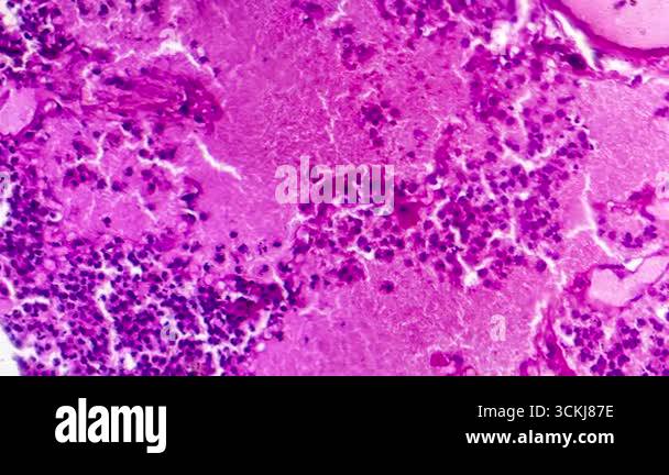 Lobar pneumonia during the hemorrhagic edema period, light microscopy ...