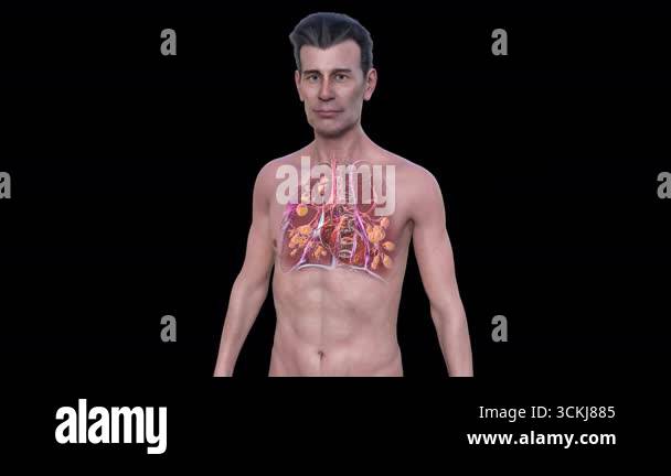 A man with lungs affected by cystic fibrosis, a genetic disorder ...