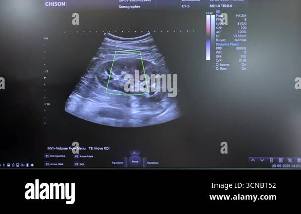 Abdominal ultrasound scan showing internal organs. Ultrasound scan of ...