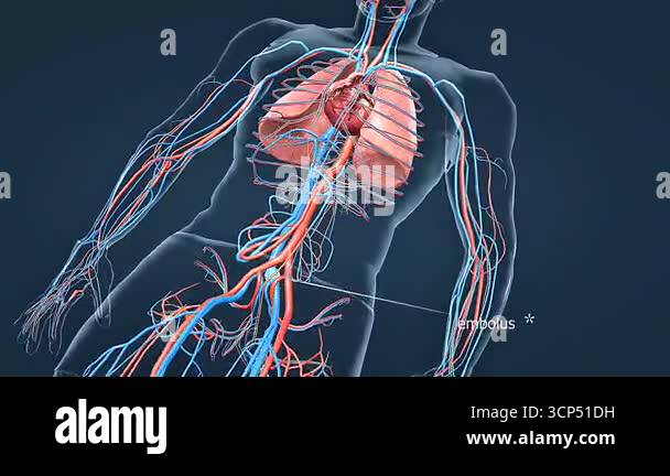 3D animation of embolus movement during pulmonary embolism, showing ...
