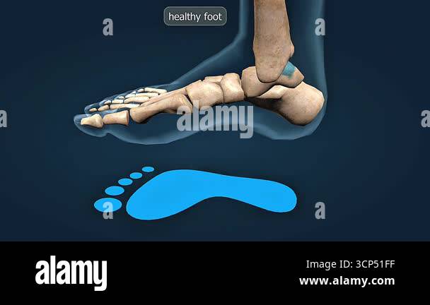 3D animation comparing healthy foot and flat foot, showing structural ...