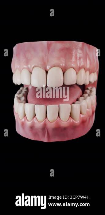 This 3d animation shows the periodontitis disease Stock Video Footage ...