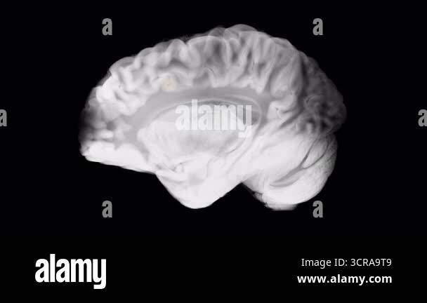 Medical animation of progressive glioblastoma growth in the left ...