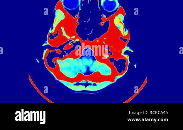 Anatomical MRI Analysis of the Human Brain: Visualizing Cerebral ...