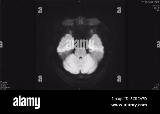 Magnetic resonance images of the brain, MRI of the brain, of a patient ...