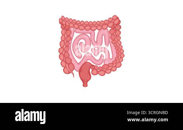 Medical animation of diverticulosis disease affecting human intestine ...