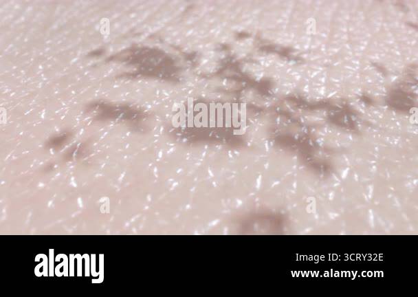 Melasma laser treatment. 3D rendering animation showing reduced melanin ...