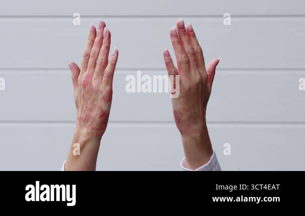 Hands showing visible symptoms of eczema and psoriasis, highlighting ...