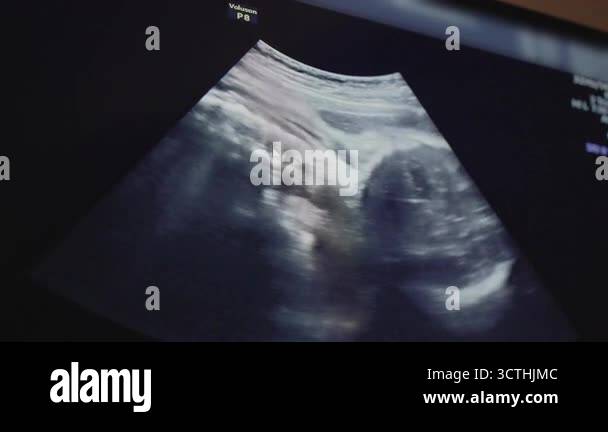 Close-up of ultrasound monitor displaying baby during pregnancy exam ...