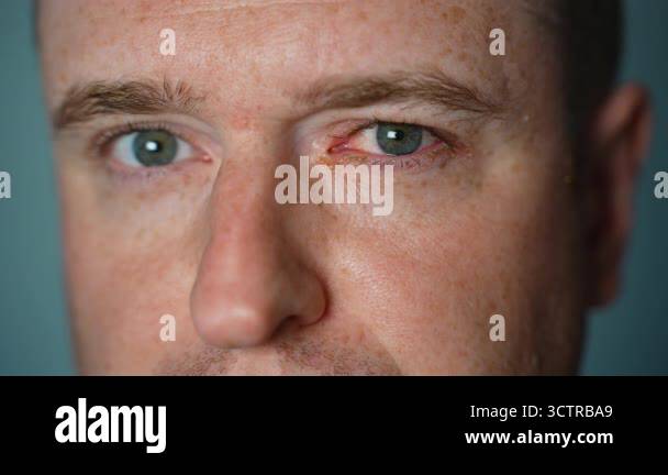 Extreme close up of a caucasian mans face showing a red and irritated ...