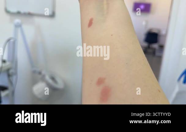 Show me your hand with three red spots, two insect bites, and a small ...