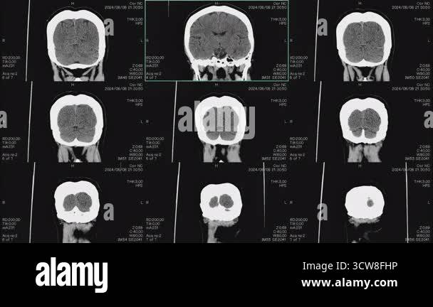 Magnetic resonance images of the head, MRI of the brain, front and top ...