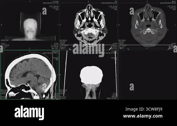 Magnetic resonance images of the head, MRI of the brain, side and top ...