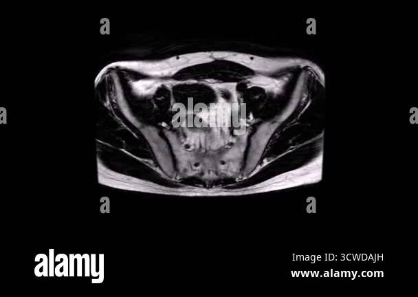 Pelvic MRI cross-section highlighting muscles, bones and surrounding ...