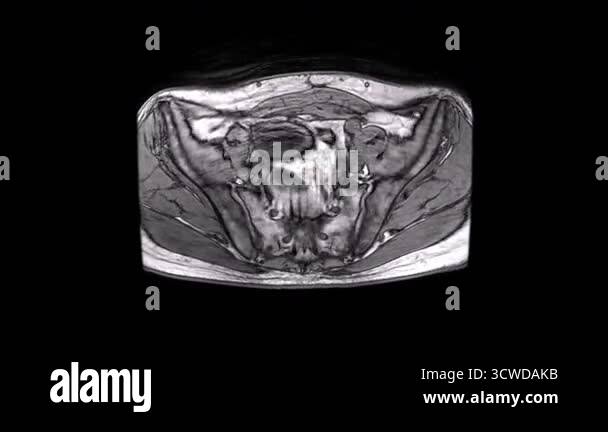 Pelvic MRI cross-section highlighting muscles, bones and surrounding ...