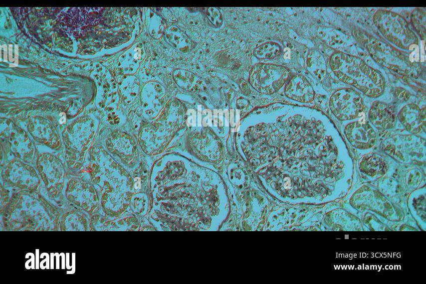 Kidney in AIDS patients with Candida yeast infection Stock Video ...