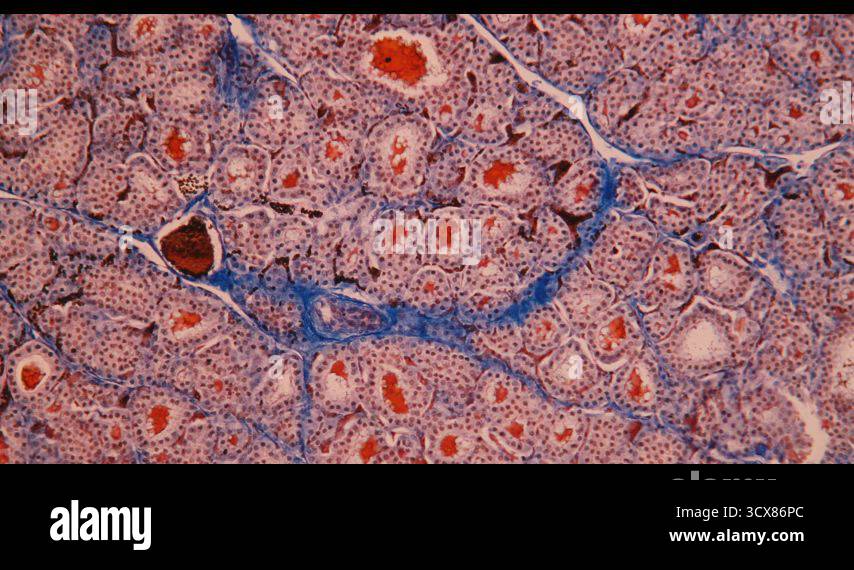 Thyroid Gland Colloid Stock Videos And Footage Hd And 4k Video Clips Alamy