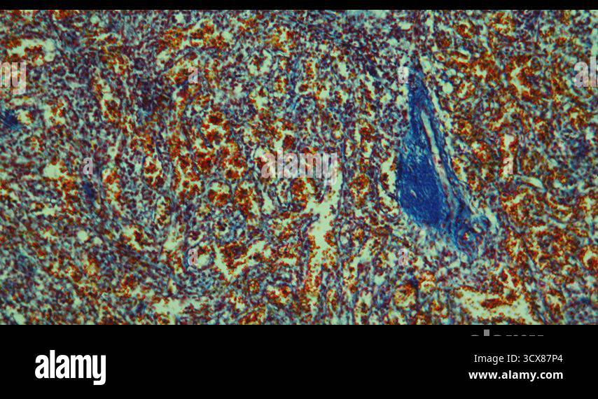 Splenic infarction tissue Stock Videos & Footage - HD and 4K Video ...