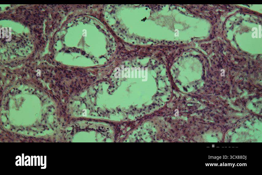 Inguinal testicles diseased Stock Video Footage - Alamy