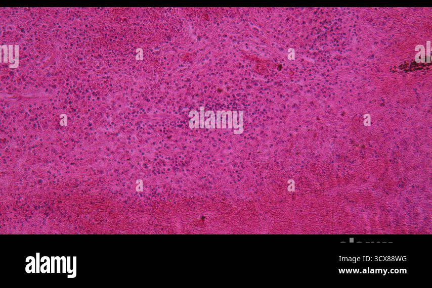 Sarcoma lymphatic gland Stock Videos & Footage - HD and 4K Video Clips ...