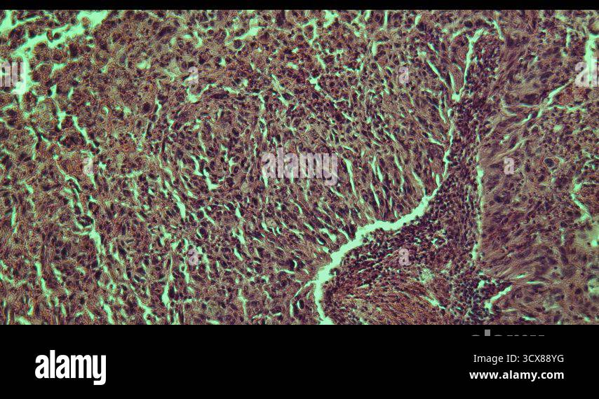 Cervical cancer tissue Stock Videos & Footage - HD and 4K Video Clips ...