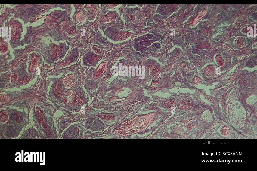 Spinalioma Stock Videos & Footage - HD and 4K Video Clips - Alamy
