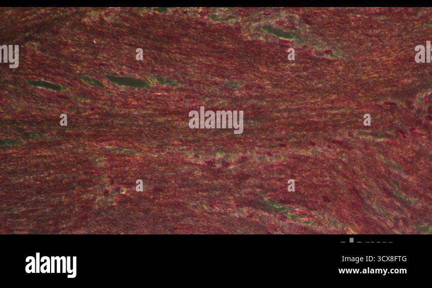 stomach carcinoma tissue in Darkfield Stock Video Footage - Alamy