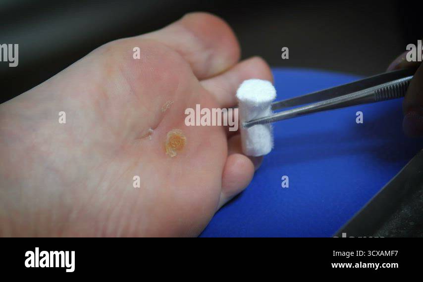 Cryotherapy verruca Stock Videos & Footage - HD and 4K Video Clips - Alamy