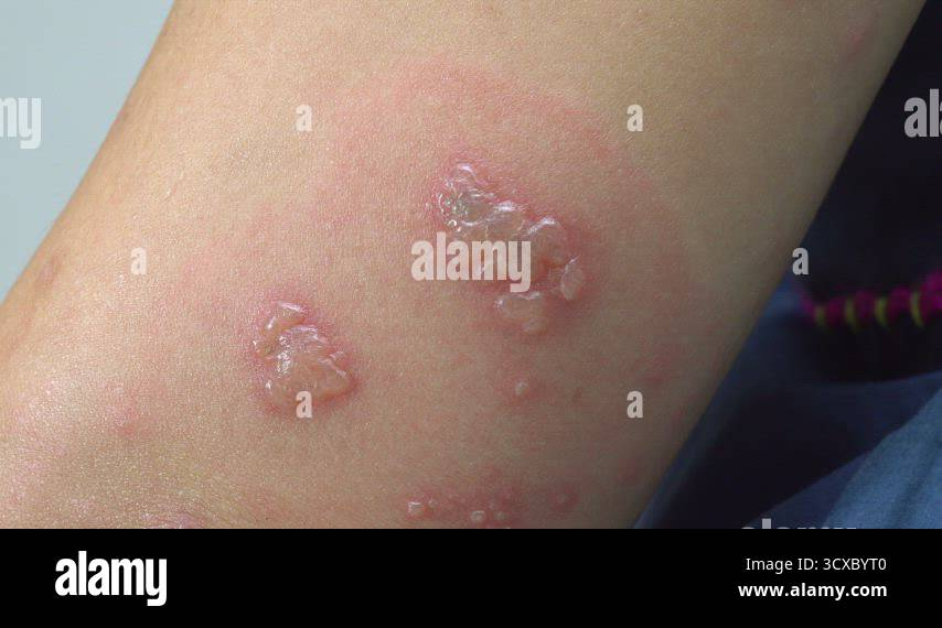 Shingles, Zoster or Herpes Zoster symptoms on arm Stock Video Footage ...