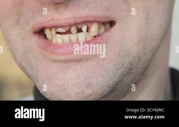 Man with bad diseased teeth affected by caries and periodontitis ...