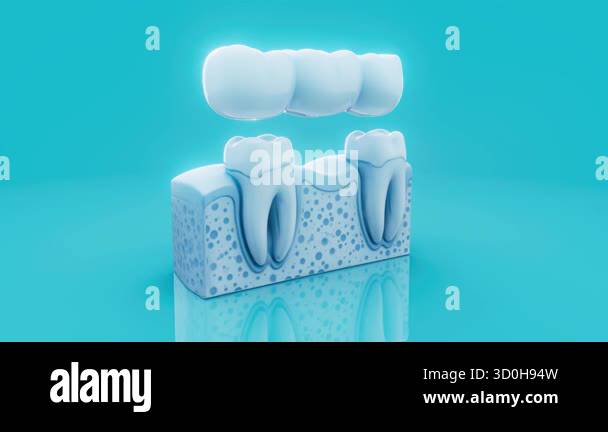 3 d render. teeth bridge with dental concept Stock Video Footage - Alamy