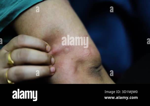 Medical dermatology skin allergy concept Stock Videos & Footage - HD ...