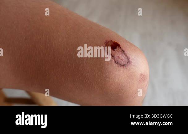 Close-up view of a knee with a wound, illustrating the bleeding process ...